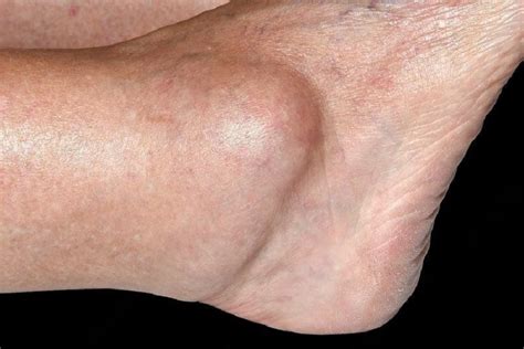 Podiatrists For Ganglion Cyst Surgery In Martindale Calgary
