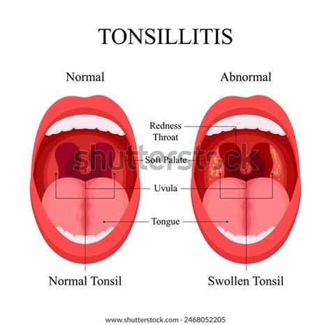 Healthy Tonsils Vs Unhealthy I Have Tonsil Stones And Bad Breath