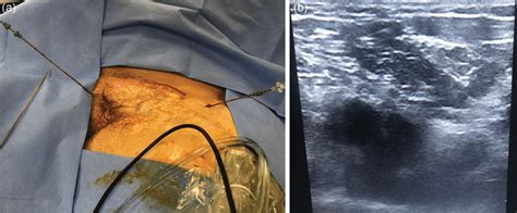 Complications Of Lateral Obturator And Lateral Femoral Nerve Block And Radiofrequency Ablation