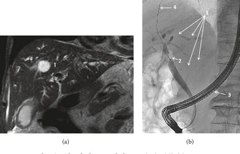 PDF University Of Southern Denmark IgG4 Related Sclerosing Cholangitis Involving The