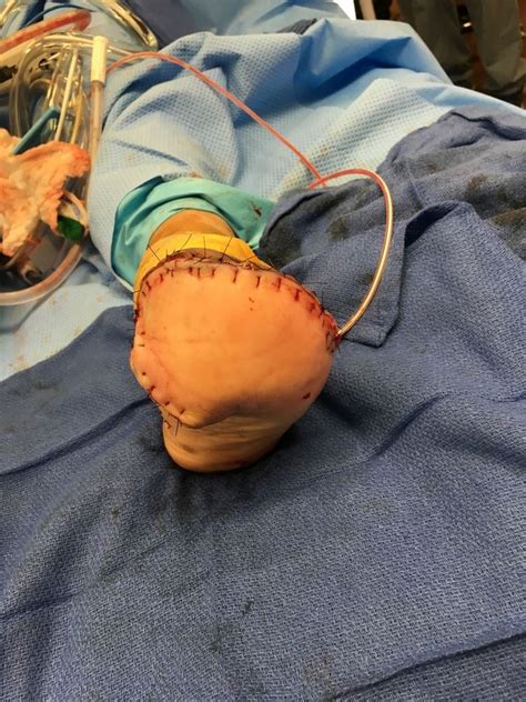 Transmetatarsal Amputation 77 Walk In Community David Armstrong