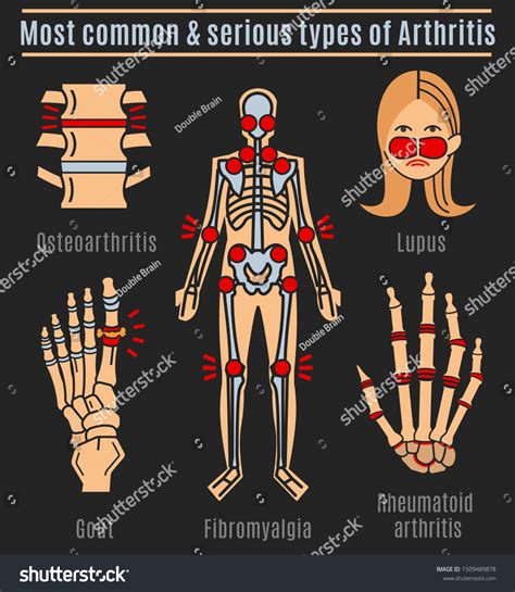 Types Of Arthritis Stock Vectors Images Vector Art Shutterstock