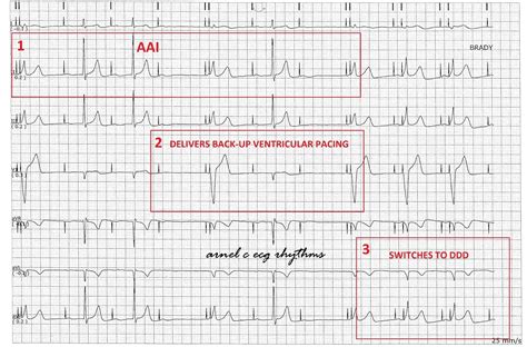 ecg rhythms looked like pacemaker malfunction but not