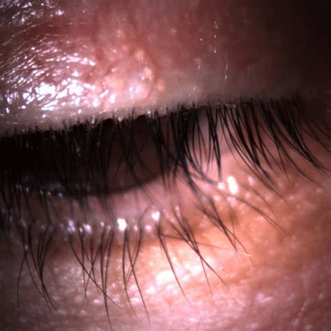 Demodex Blepharitis Xdemvy® Lotilaner Ophthalmic Solution 0 25