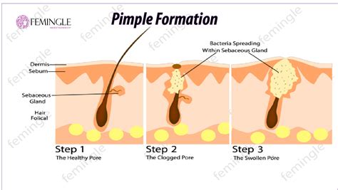 How To Control Pimples Naturally Femingle
