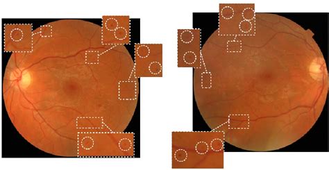 Figure 1 From Automatic Detection Of Microaneurysms In Fundus Images Using An Ensemble Based