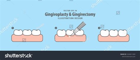 Gingivectomy Electrosurgery At Alan Rayl Blog