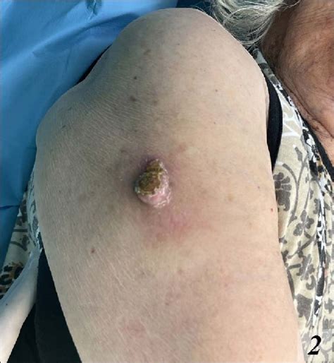 In The Right Forearm Area A Rounded Tumor Like Lesion With Superficial Download Scientific
