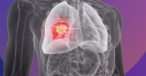 Targeted Therapy For Nsclc Antibody Drug Conjugates