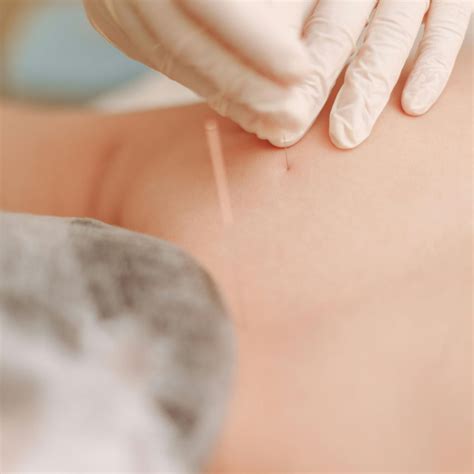Dry Needling Vs Acupuncture Understanding The Key Differences China Gel Shop