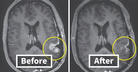 Glioblastoma Patient Sees Tumor Almost Disappear In Days Thanks To New