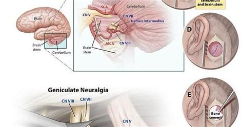 Geniculate Neuralgia Album On Imgur