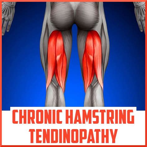 Hamstring Tendinopathy Treatment At Donald Frame Blog
