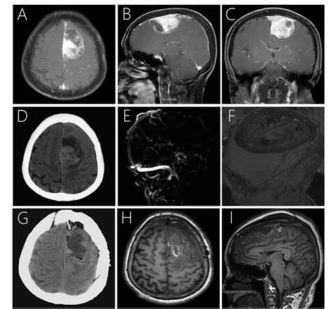 Figure 1 From Primary Intracranial Ewing Sarcoma Peripheral Primitive Neuroectodermal Tumor