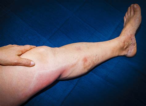 What Causes Lumps Under The Skin On Legs