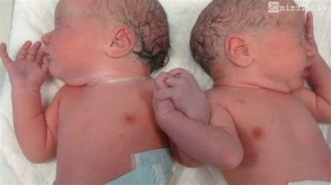 Acrocyanosis Peripheral Cyanosis Of Hands And Feet Newborn Twins
