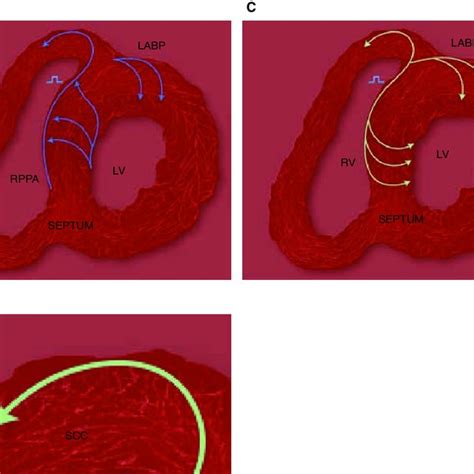 Comparison Of Excitation Pathways In Normal Activation And In Ns Hbp