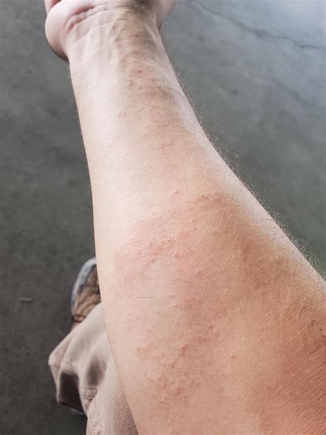 Itchy Rash Been On Both Forearms For 3 To 4 Weeks Now R
