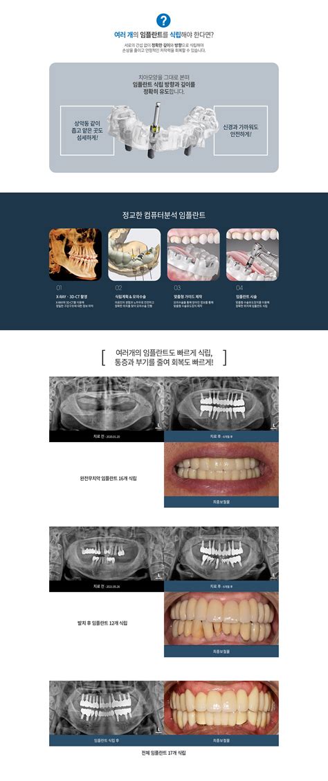 컴퓨터분석 임플란트 서울스마트치과의원