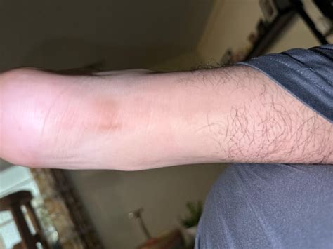 Hemosiderin Deposits R Skincareaddicts