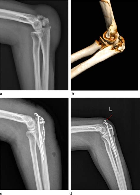 A 33 Year Old Man Treated With Free Hand Tbw For Olecranon Fracture Download Scientific