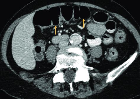Abdominal Contrast Enhanced Ct Scan Showing Edematous Thickening Of The Download Scientific