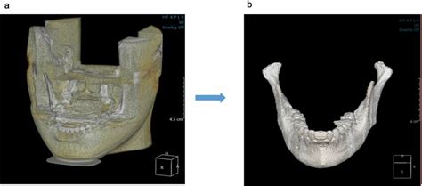 Binarization Of The Mandible A Representation Of The Processed 3d