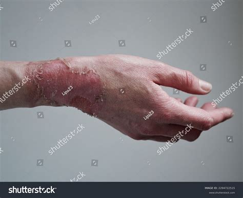 Skin Burn Scar