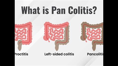 Pancolitis Inflammation Of Entire Colon Definition Causes