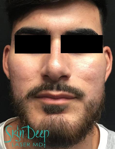 Peel Skin Deep Laser Md