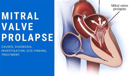 Mitral Valve Prolapse Definition Vcog