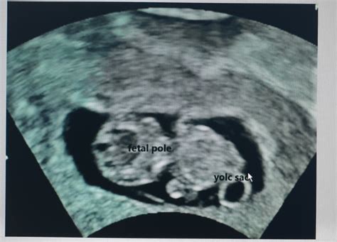 Fetal Sex Prediction Measuring Yolk Sac Size And Yolk Sac Fetal Pole