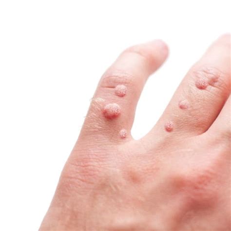 Warts On The Hands How Do You Get Rid Of Them