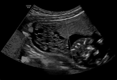 Posterior Fundal Subchorionic Hematoma Measuring 3 4 Cm Â 0 65 Cm Download Scientific Diagram