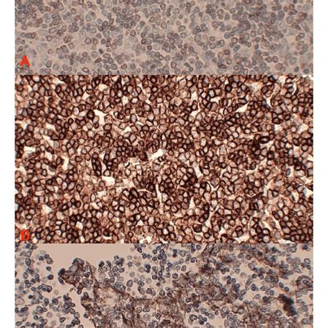 A Cd3 Staining Of Resected Thymoma Immunohistochemistry Low Power