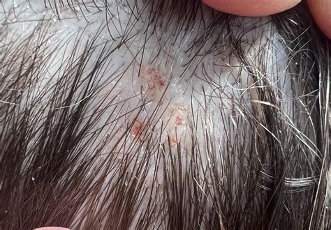 Random Scaly Red Lesions On Scalp Is This Concerning R Dermatology