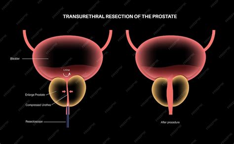 Premium Vector Transurethral Resection Of The Prostate Turp Medical