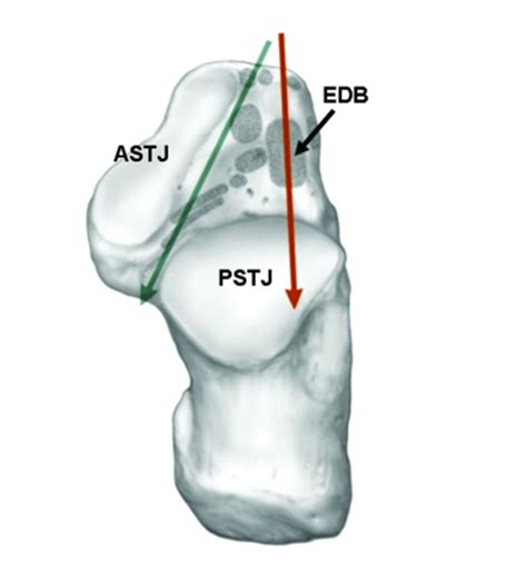 Sonographically Guided Posterior Subtalar Joint Injections Via The