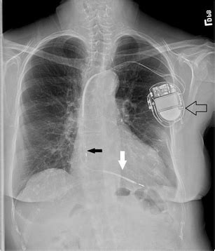 Chest X Ray Of Patient With Pacemaker With Defibrillator Functionality Download Scientific