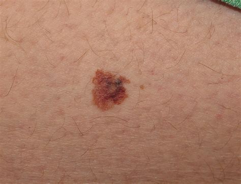 What Causes Skin Melanoma At Janice Bourn Blog