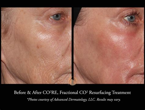 Fractionated Co2 Laser Co2 Laser Skin Resurfacing With Sculptra Facial