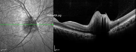 Optic Nerve Drusen Retinara