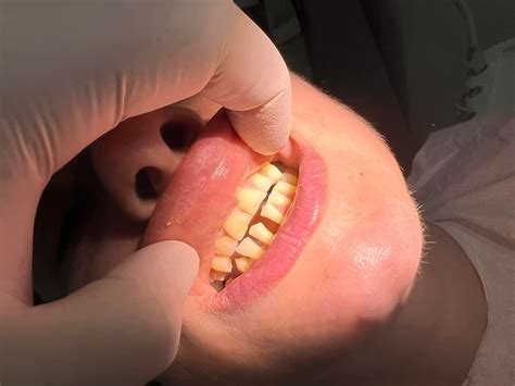 🦷ანატომიური ცირკონის Dental Leader დენტალ ლიდერი Facebook