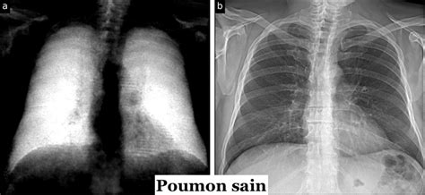La Radiographie Pulmonaire à Fond Noir Améliore