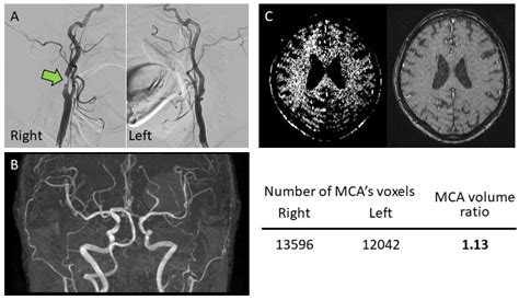 The Middle Cerebral Artery Mca Volumeratio Of Subjects Was