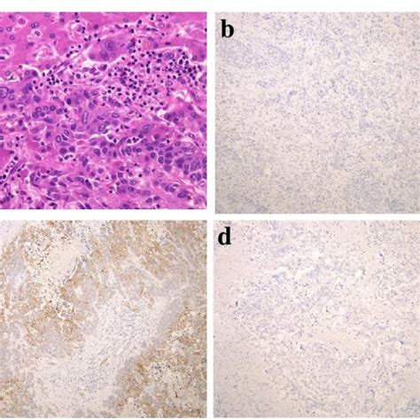 Pdf Intrahepatic Cholangiocarcinoma Coinciding With A Liver Metastasis From A Rectal Carcinoma