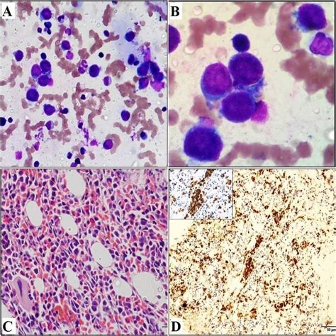 Bone Marrow Aspirate A B And Biopsy C D Showing Infiltration By Download Scientific