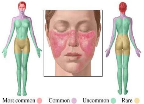 Lupus Quali Sono I Sintomi Della Malattia
