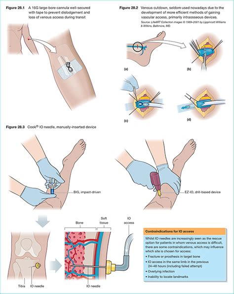 Peripheral Vascular Access Anesthesia Key