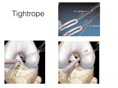 Acl Graft Fixation Options Ppt Free Download